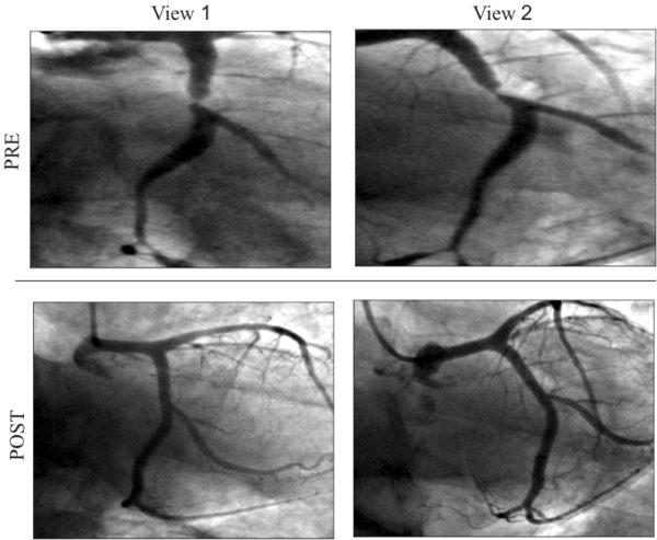 Bi-dimensional analysis of angiographic images before and after ...