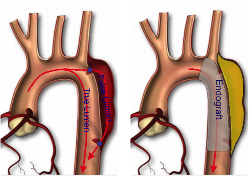 Aortic endografting | Compmech