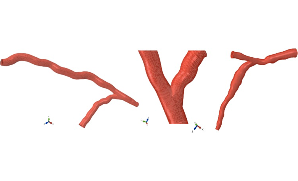 3D bifurcation coronary reconstruction from angiographic images | Compmech