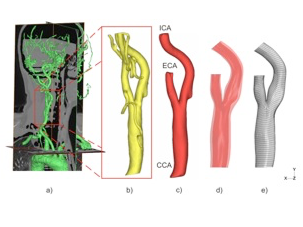 Carotid Artery stenting simulation: from DICOM to FEA | Compmech